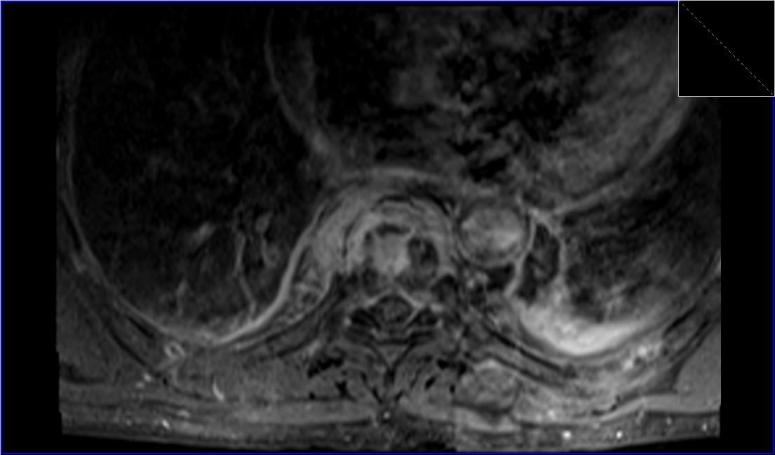 Discitis MRI | Radiology article on how to report Spondylodiscitis