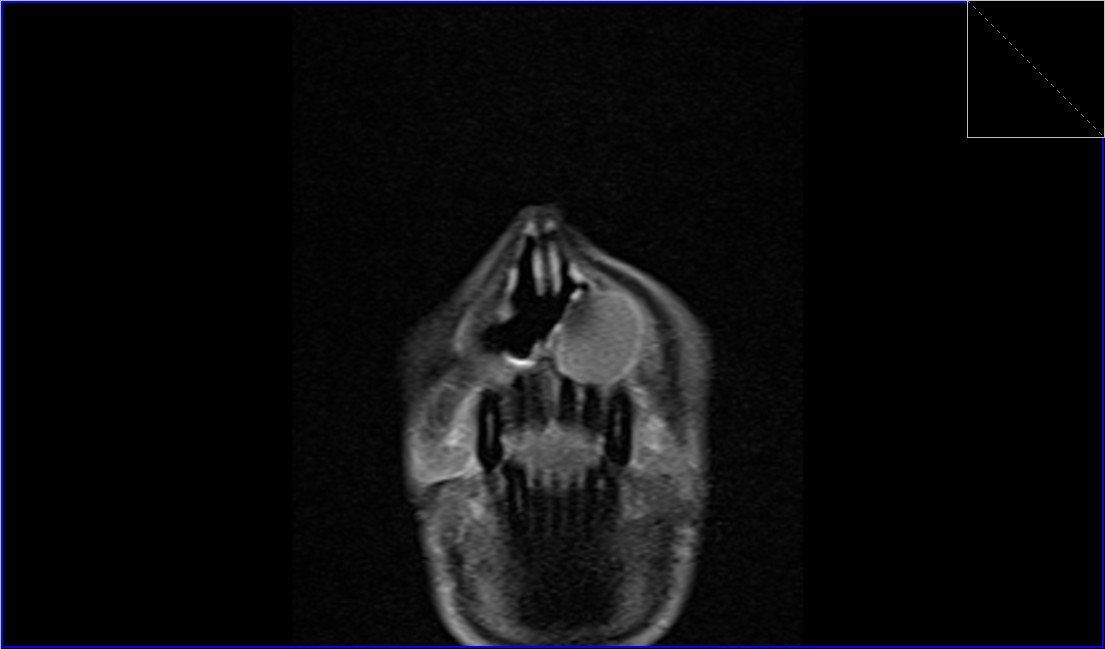 Epidermoid cyst MRI | Radiology Article on MRI of Epidermoid Cysts