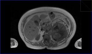 Renal cell carcinoma (RCC) MRI