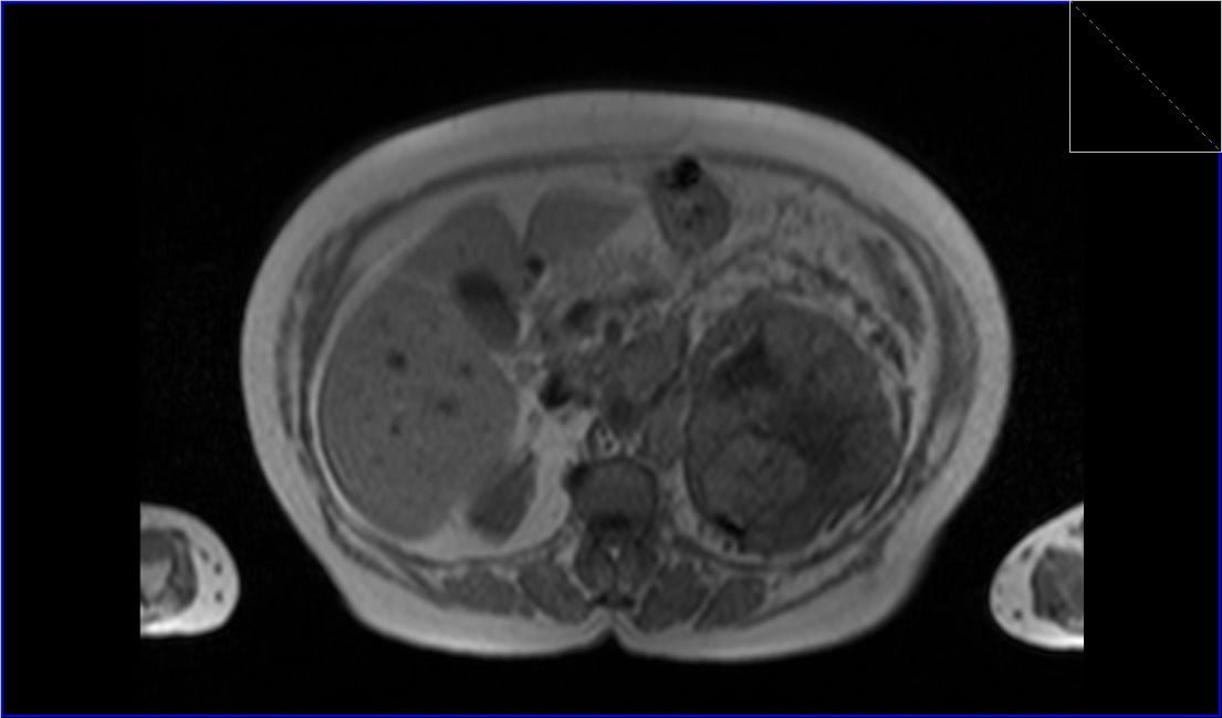 Renal cell carcinoma (RCC) MRI