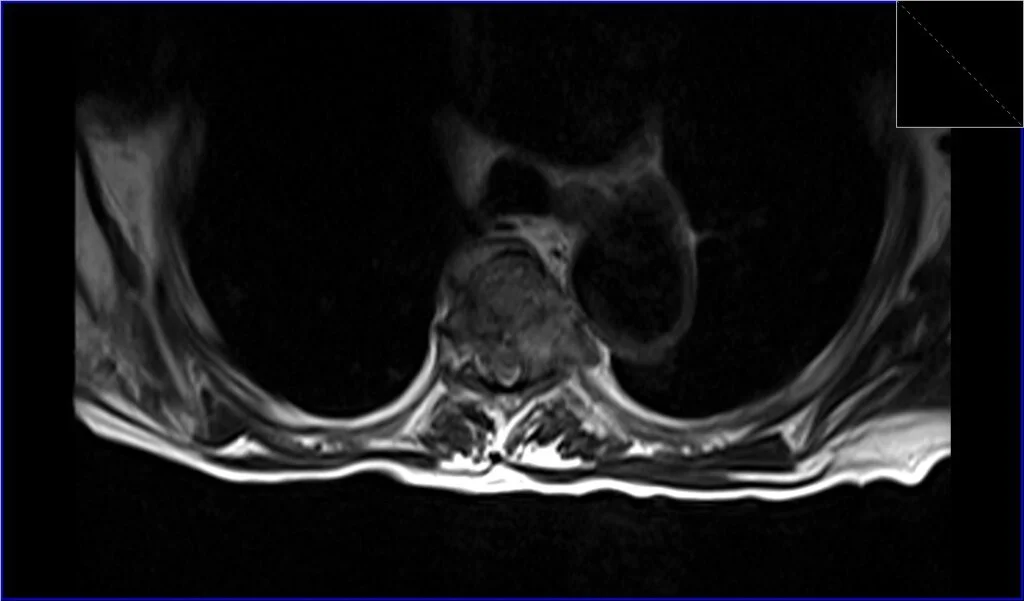 Spinal Cord Compression