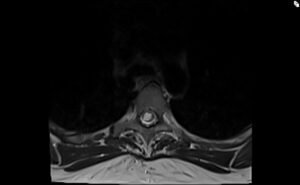 Syringomyelia MRI | Radiology article on syrinx