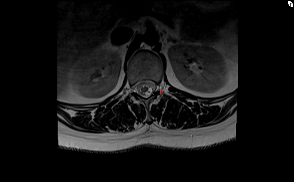 Lipoma of the conus medullaris MRI | Radiology article on spinal lipomas