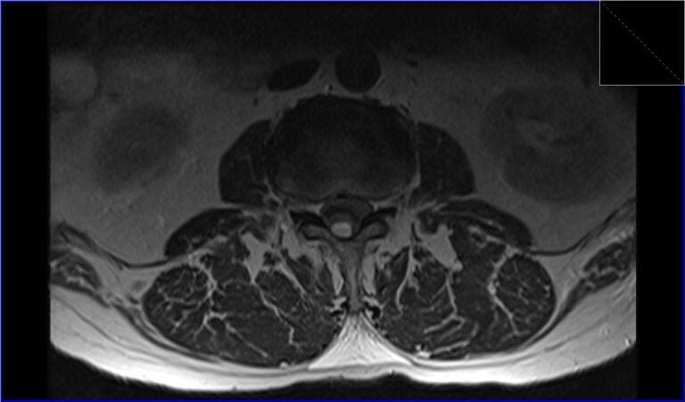 Spinal Seroma MRI | Radiology article on how to report Seroma