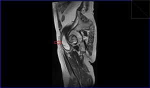 Iliopsoas Bursitis MRI | Iliopectineal bursitis radiology article
