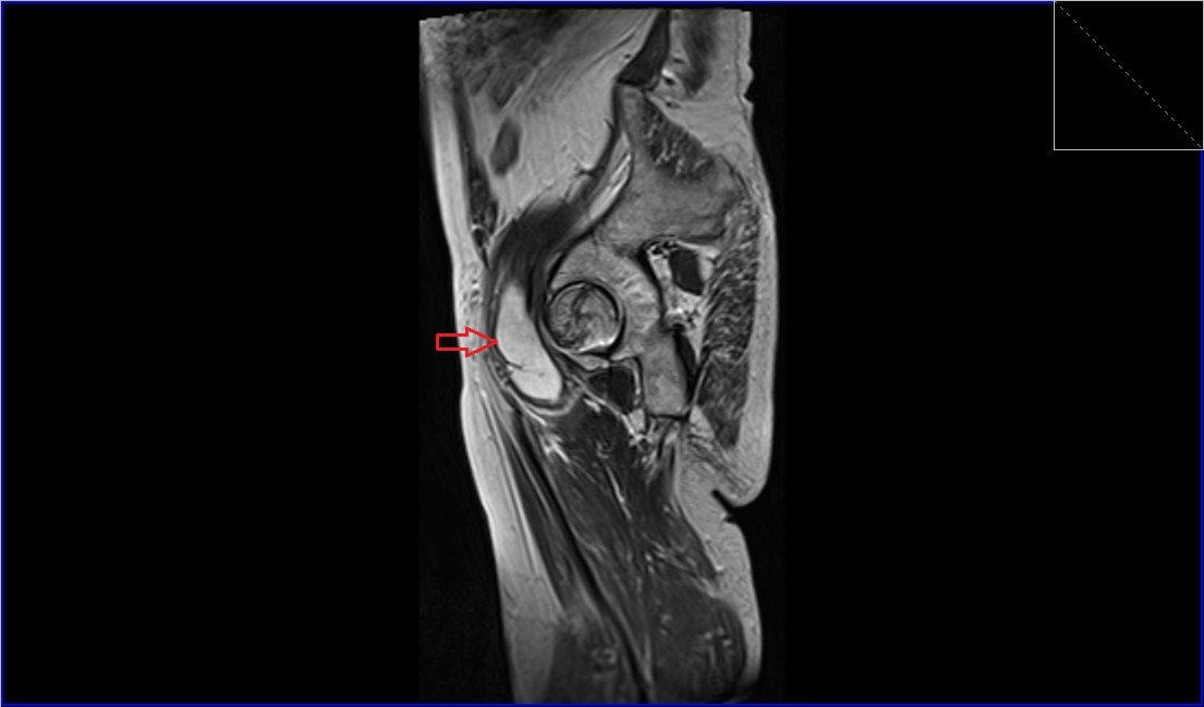 Iliopsoas Bursitis MRI | Iliopectineal bursitis radiology article