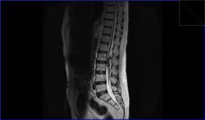 Spinal Seroma MRI | Radiology article on how to report Seroma