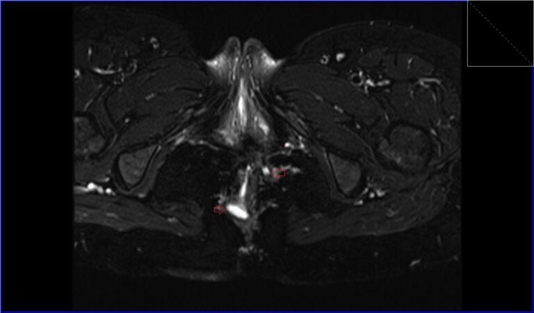Anorectal Fistula MRI | Perianal fistula radiology