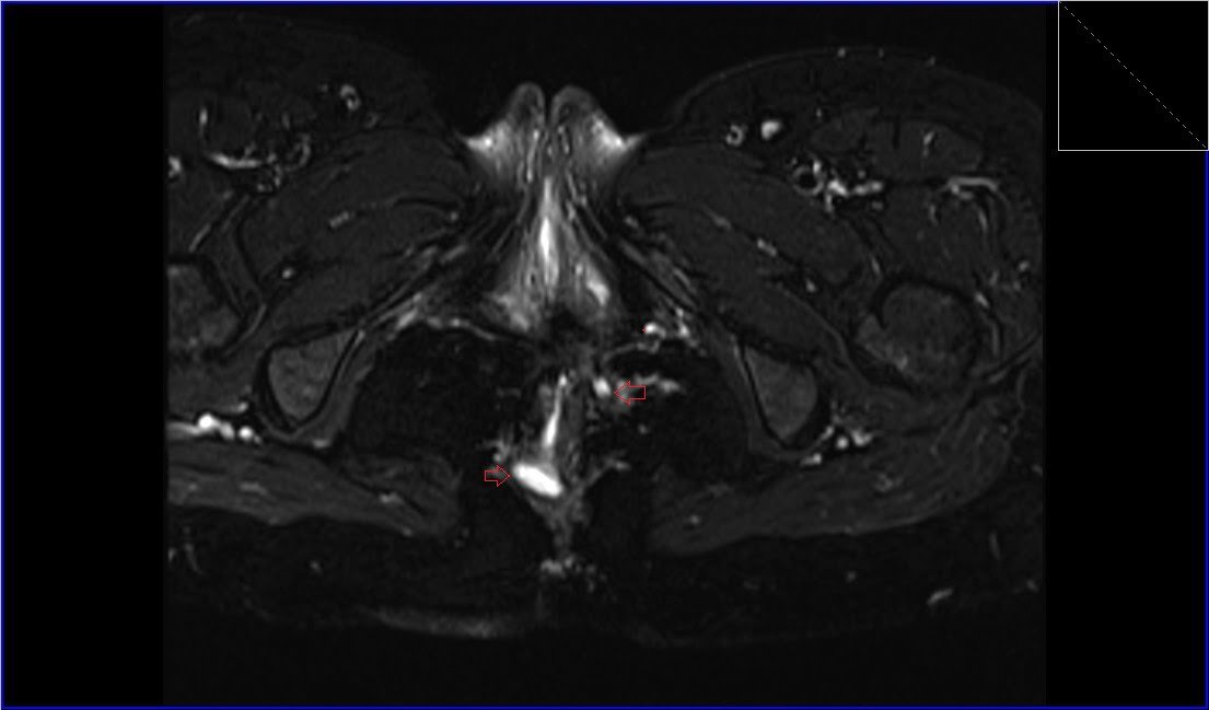 Anorectal Fistula MRI | Perianal fistula radiology