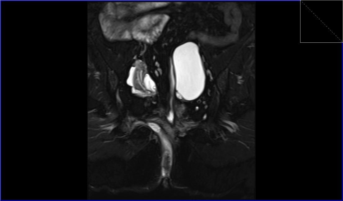Anorectal Fistula MRI | Perianal fistula radiology