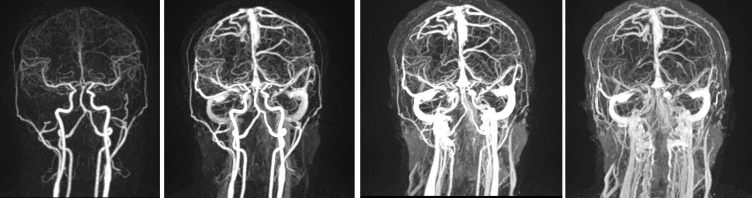 Cavernous Sinus MRI | MRI Cavernous Sinus Protocol and Planning