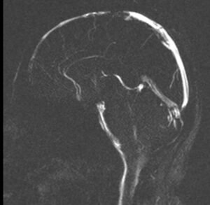 Cerebrospinal fluid flow MRI | CSF flow MRI protocol and planning