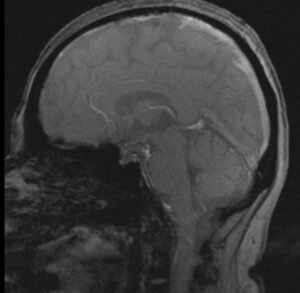 Cerebrospinal fluid flow MRI | CSF flow MRI protocol and planning