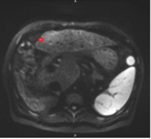 Hepatocellular carcinoma (HCC) MRI