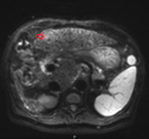 Hepatocellular carcinoma (HCC) MRI