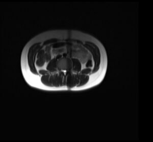 MRI localizer (scout or survey scan) | T1,T2 and 3D localizers