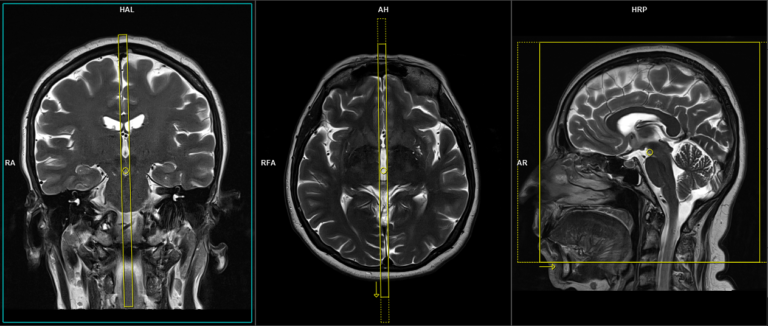 Cerebrospinal fluid flow MRI | CSF flow MRI protocol and planning