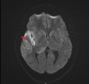 MRI Encephalitis | Radiology article on herpes simplex encephalitis