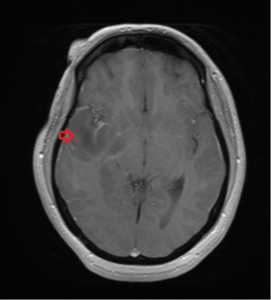 MRI Encephalitis | Radiology article on herpes simplex encephalitis