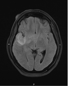 MRI Encephalitis | Radiology article on herpes simplex encephalitis