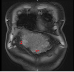 Hepatocellular carcinoma (HCC) MRI