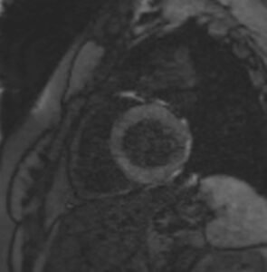 TI scout (look-locker) MRI | TI scout cardiac MRI