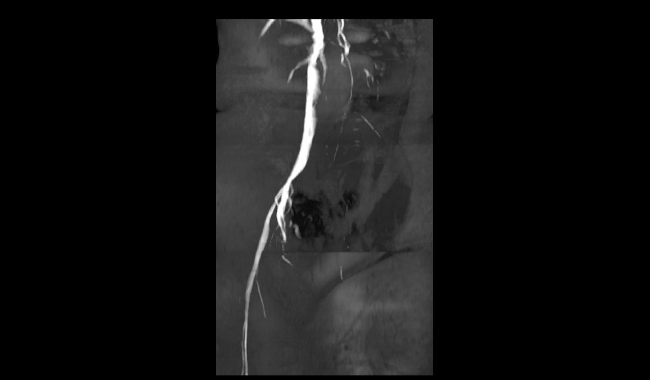 Iliofemoral deep vein thrombosis (DVT) MRI