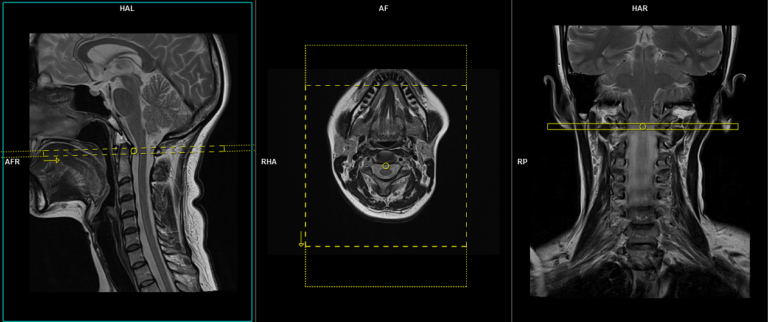 CSF Flow Chiari I Malformation MRI | Chiari I Malformation MRI protocol ...