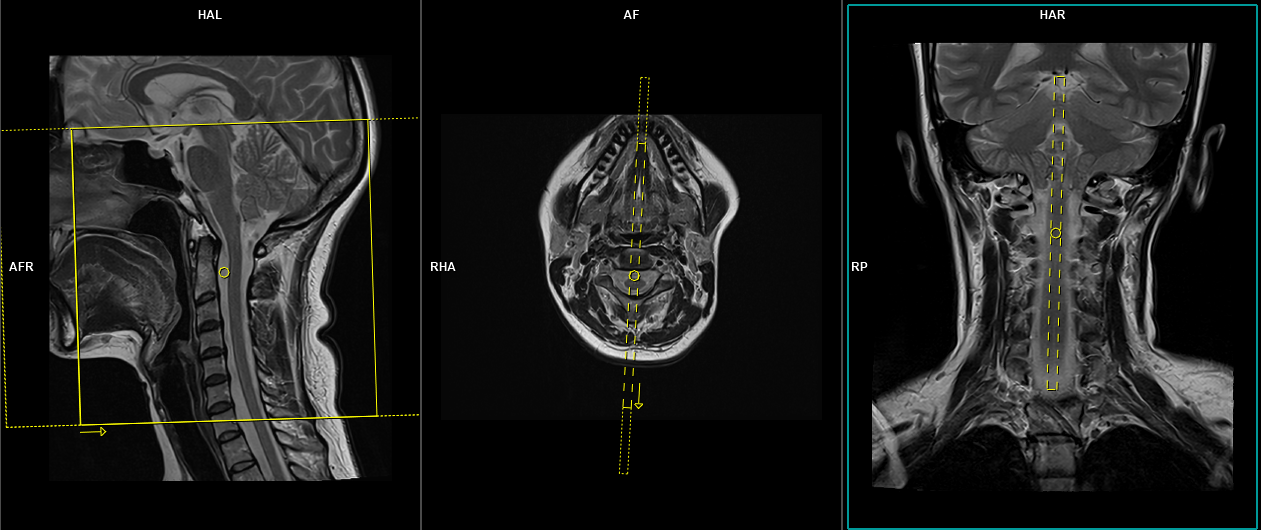 CSF Flow Chiari I Malformation MRI | Chiari I Malformation MRI protocol ...