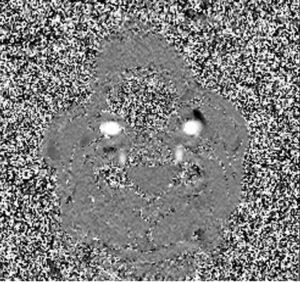 MRI Velocity Encoding (VENC) MRI