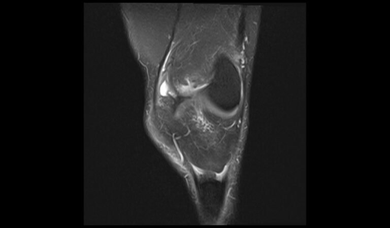 Chondromalacia MRI | Radiology Article on chondromalacia patellae