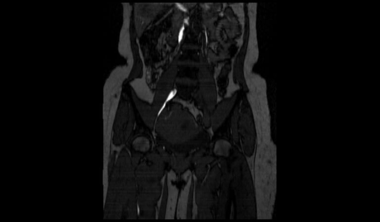 Iliofemoral deep vein thrombosis (DVT) MRI