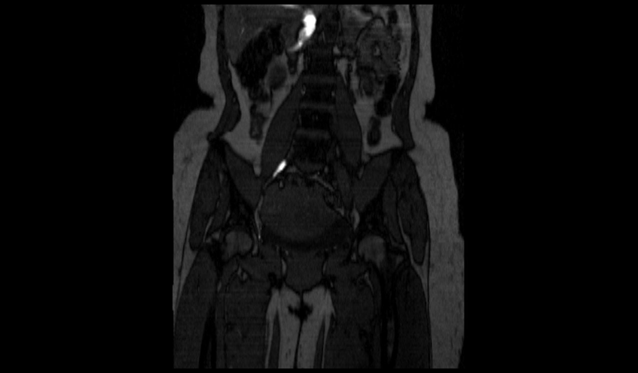 Iliofemoral deep vein thrombosis (DVT) MRI