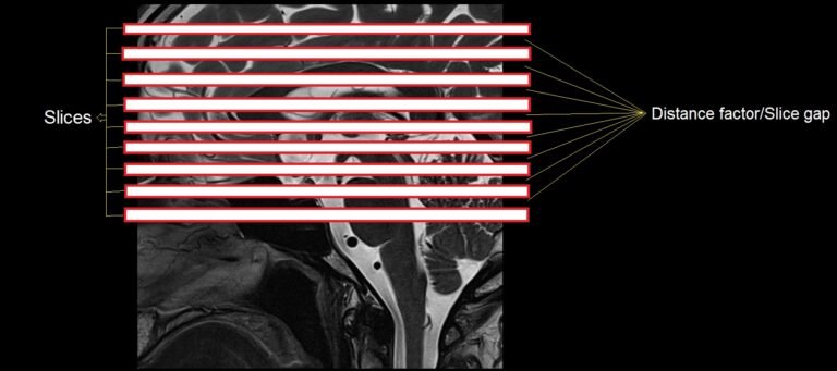 MRI distance factor / Slice gap