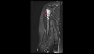 Enchondroma MRI | Radiology Article on Enchondroma MRI