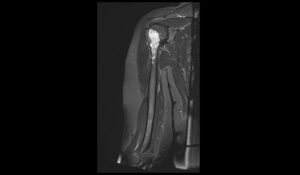 Enchondroma MRI | Radiology Article on Enchondroma MRI