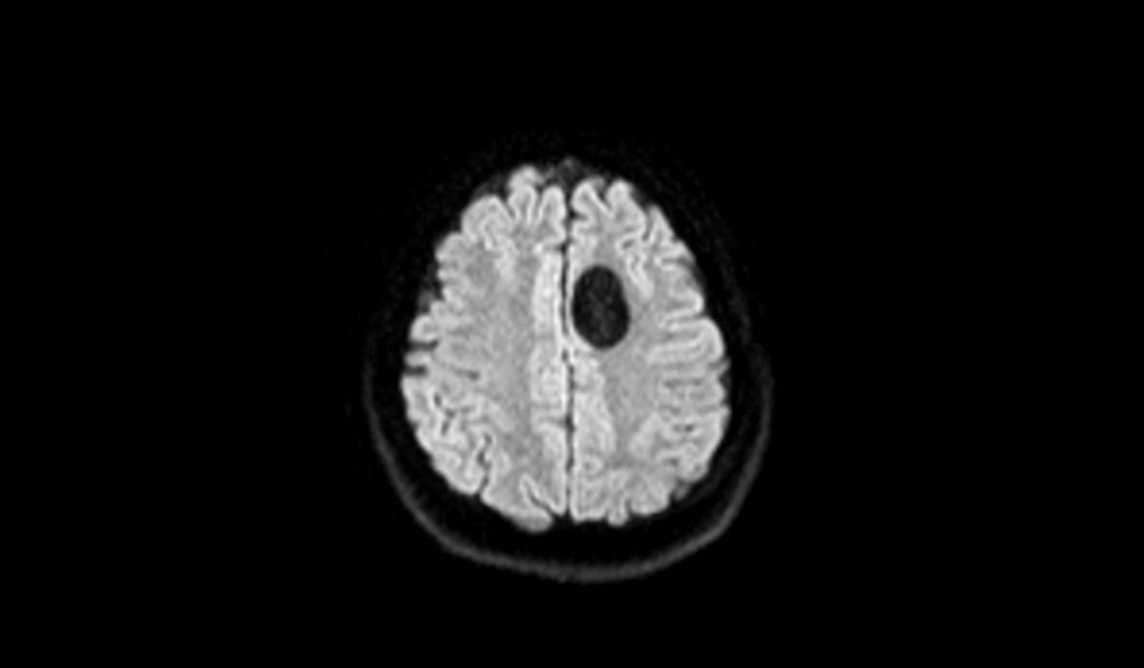 Neuroglial Cysts MRI | Radiology Article on Glioependymal Cysts