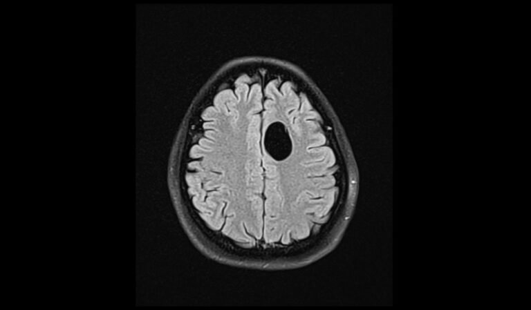 Neuroglial Cysts MRI | Radiology Article on Glioependymal Cysts