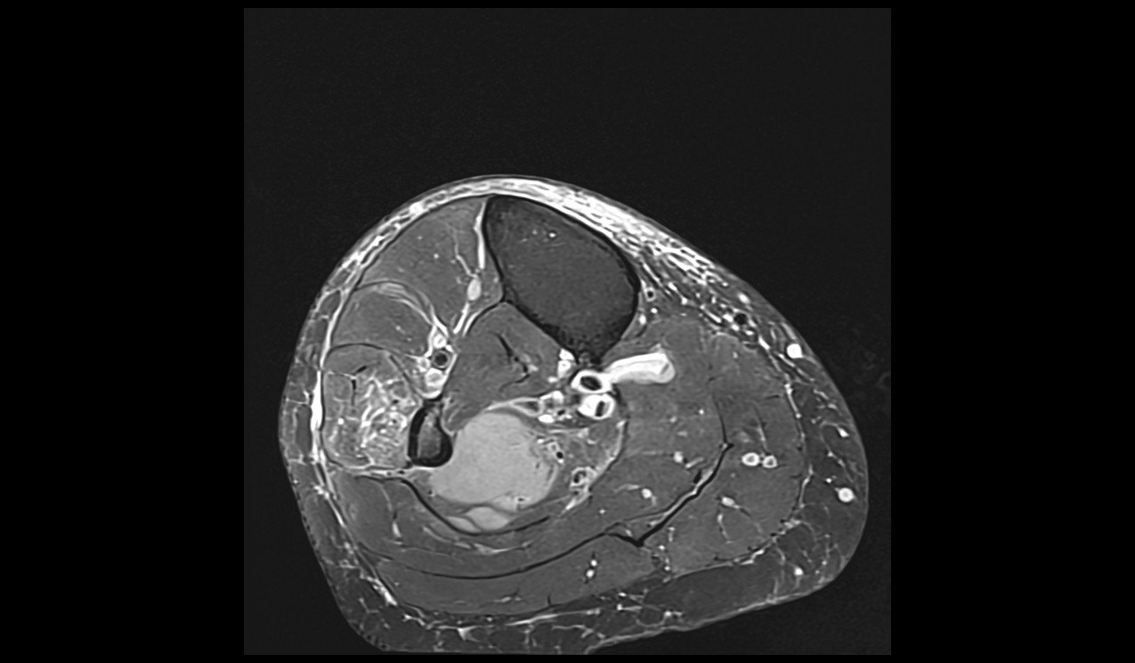 Knee Lymphoma MRI | Radiology Article on Knee Lymphoma