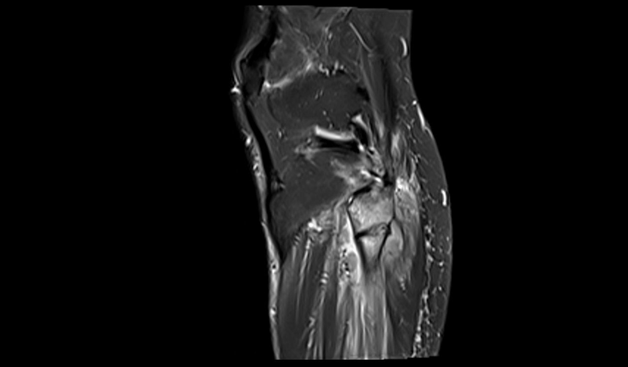Knee Lymphoma MRI | Radiology Article on Knee Lymphoma