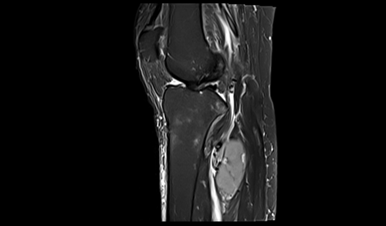 Knee Lymphoma MRI | Radiology Article on Knee Lymphoma