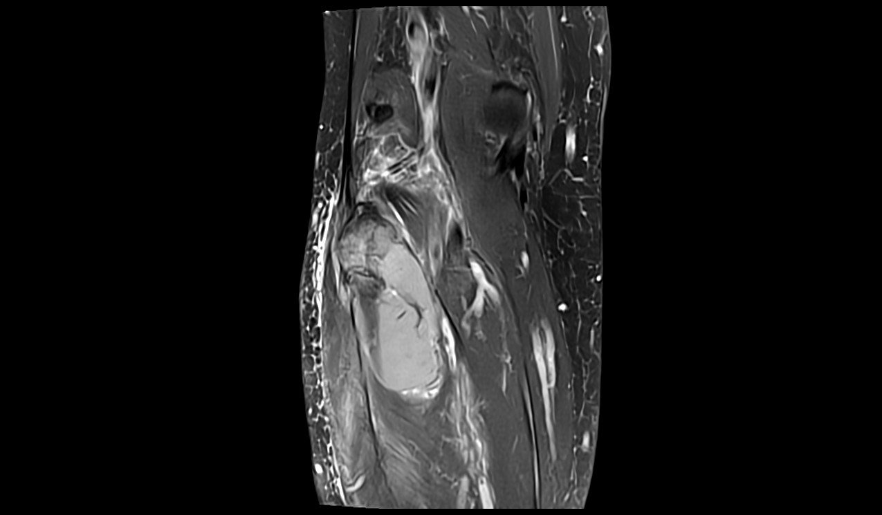Knee Lymphoma MRI | Radiology Article on Knee Lymphoma