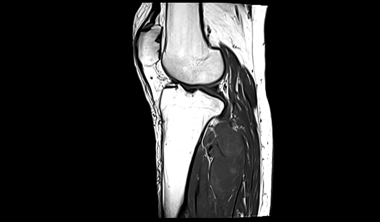 Knee Lymphoma MRI | Radiology Article on Knee Lymphoma