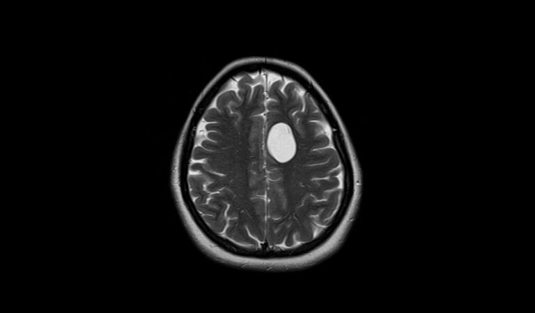 Neuroglial Cysts MRI | Radiology Article on Glioependymal Cysts