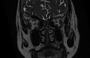 MRI cisternography (CSF Rhinorrhea) | CSF Rhinorrhea MRI protocol and ...