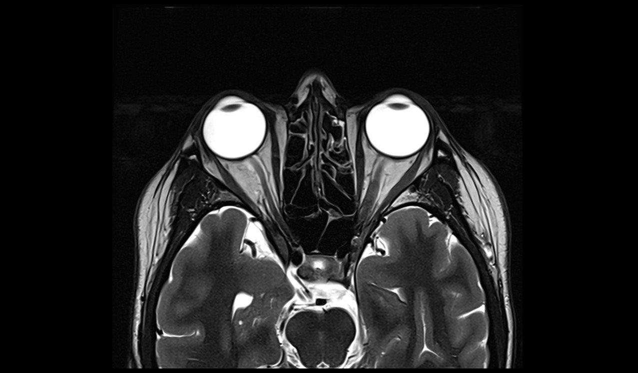 MRI cisternography (CSF Rhinorrhea) | CSF Rhinorrhea MRI protocol and ...