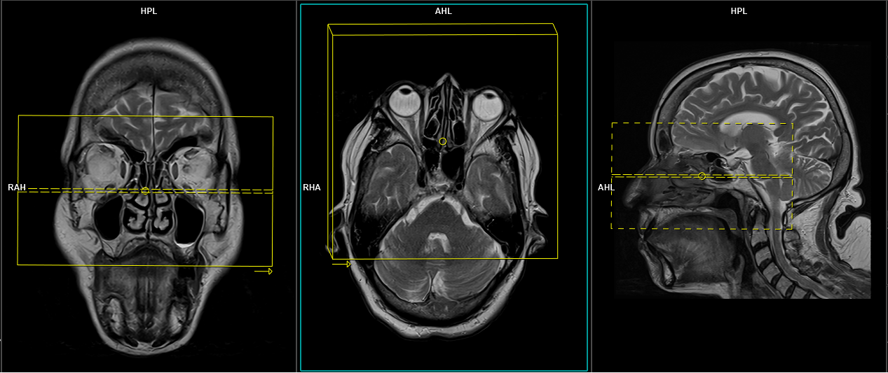 MRI cisternography (CSF Rhinorrhea) | CSF Rhinorrhea MRI protocol and ...