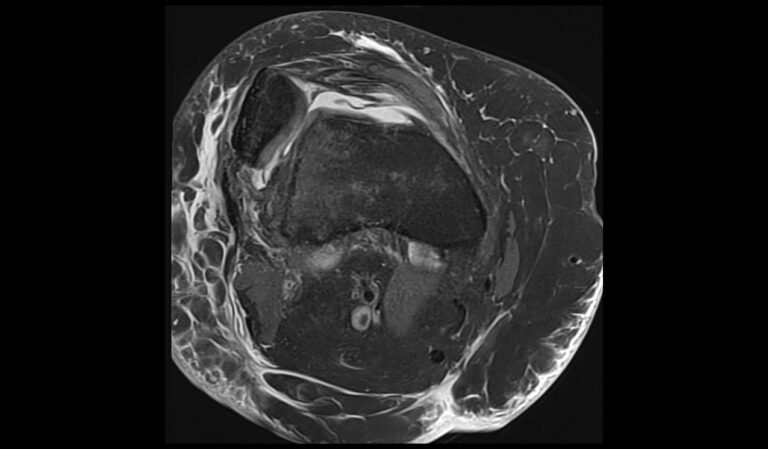 Patellar Dislocation MRI | Radiology Article on Patella Dislocation