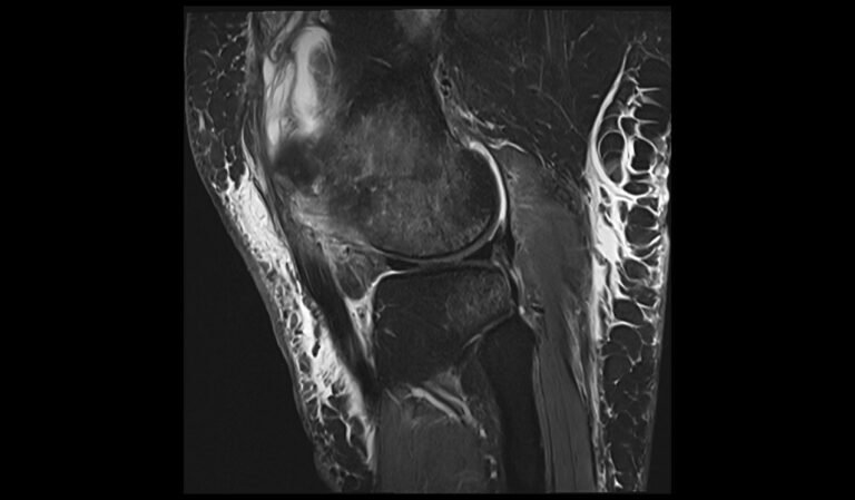 Patellar Dislocation MRI | Radiology Article on Patella Dislocation