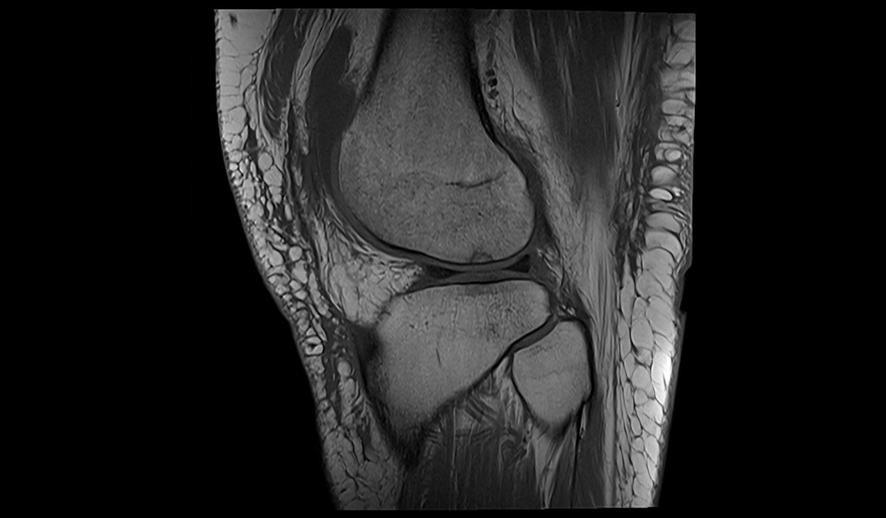 Patellar Dislocation MRI | Radiology Article on Patella Dislocation